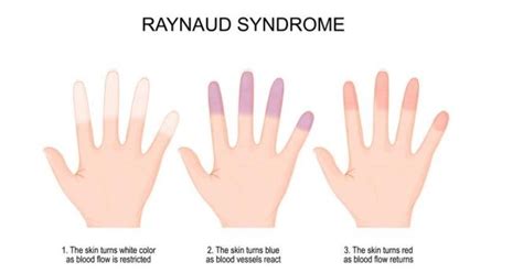 What Is Raynauds Disease Symptoms Causes Diagnosis And More