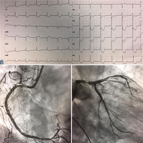 Lorenzo Azzalini On Linkedin 80 Yo Presenting With Chest Pain And