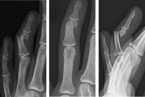 Nx Nail Fixation Of A Displaced Head Of P2 Phalanx Fracture
