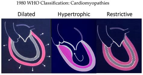 Storytelling Of Hypertrophic Cardiomyopathy Discovery