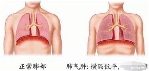 正常胸廓和异常胸廓的区别是什么？ 正常胸廓和异常胸廓是临床执业医师考试中会涉及的相关知识，为帮助大家更好的复习，整理了“正常胸廓和异常胸廓的