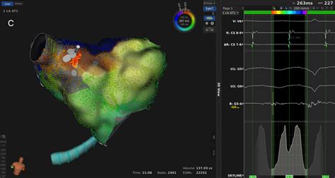 Electroanatomic Mapping Of The Left Atrium Performed With The