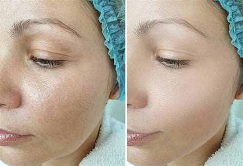 Chemical Peel Recovery Time And Aftercare Tips Collective Aesthetics