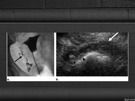 Journal Club Genitourinary Tuberculosis Ppt Ppt