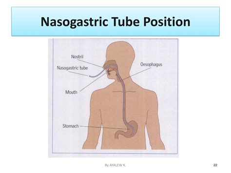 Nasogastric Tube Insertionpdf