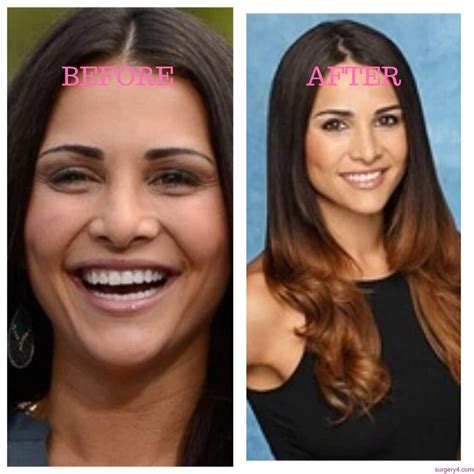 Andi Dorfman Plastic Surgery Photos Before And After Surgery4
