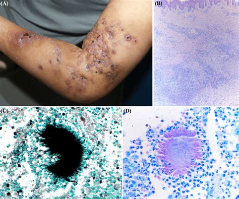 A Abscesses And Nodules On The Left Arm B Extensive Inflammatory Download Scientific Diagram
