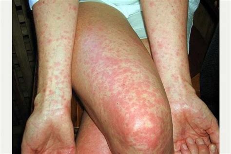 Toxoplasmosis Rash