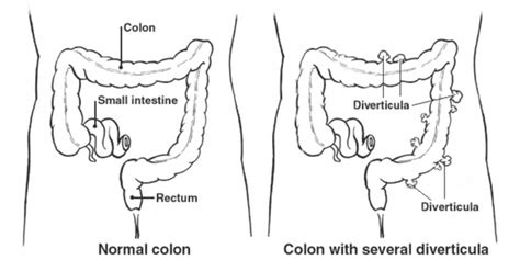 Colorectal Disease Treatment Dr Venkatesh Pabbisetti