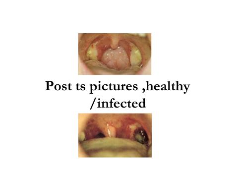 Tonsillitis 1 Ppt Ppt
