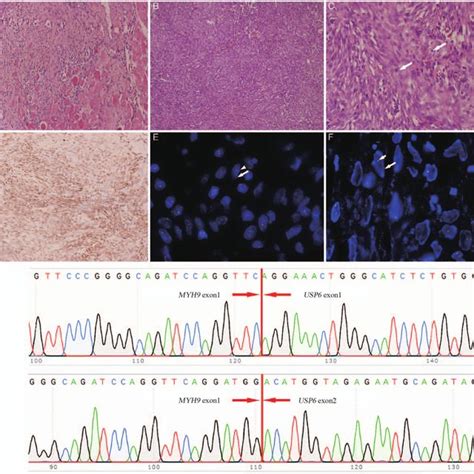 Pathological And Molecular Findings A Surrounding Muscle Invasion