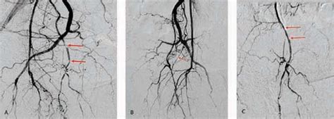 Angiogram Showing Multisegment Focal Stenosis Of Right Internal