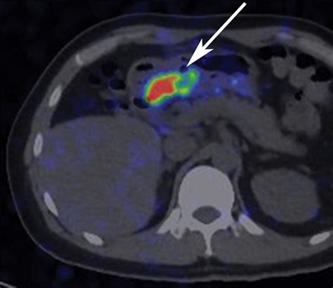 Complications Of 90y Transarterial Radioembolization Of Hepatic Tumors Primer For