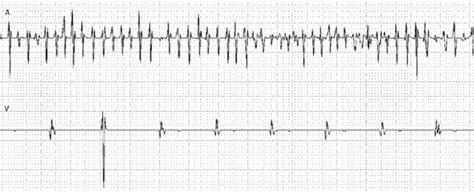 Example Of Atrial High Rate Episode Download Scientific Diagram