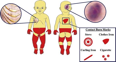 Types Of Burn Patterns At Chris Page Blog