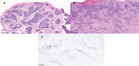 Woo Cheal Cho Md Fcap On Linkedin Gene Fusion Driven Cutaneous