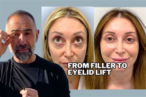 Goodbye Under Eye Bags From Filler To Eyelid Lift