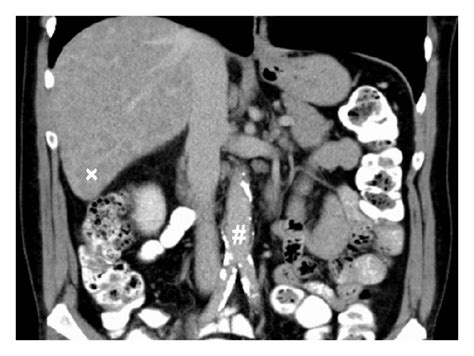 Abdominal Ct Scan Showing Diffuse Calcifications Of The Infrarenal