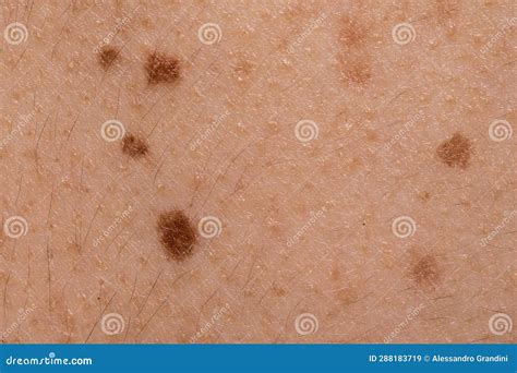 A Macro View Of Benign Nevi On Caucasian Skin Stock Image Image Of