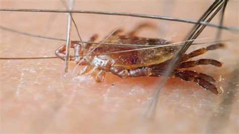 Diseases From Ticks And Mosquitos On The Rise