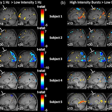Tms To Dlpfc Produces No Activation In The Targeted Area We Contrasted Download Scientific