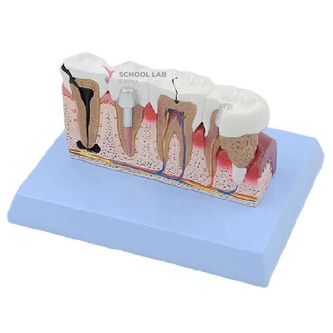 Teeth Common Pathologies Model Manufacturers Suppliers And Exporters