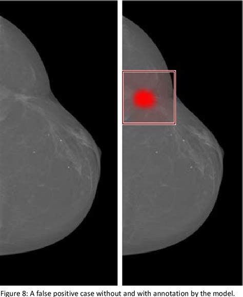 Figure 8 From A Two Stage Mammography Classification Model Using Explainable Ai For Roi
