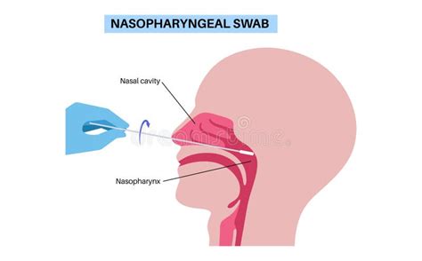 Nasopharyngeal Swab Procedure Stock Illustrations 16 Nasopharyngeal