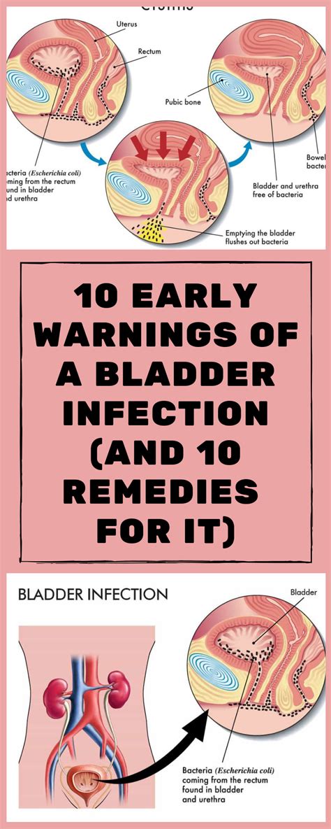 Symptoms Of Cystitis Bladder