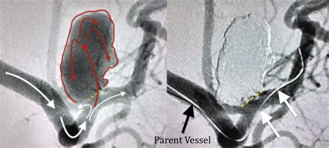 Cerebral Angiogram Procedure Unveiling The Power Of This Test