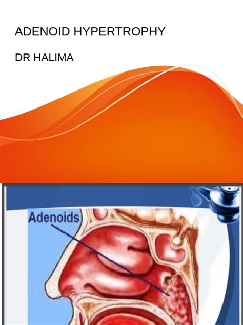 Management Of Adenoid Hypertrophy Pdf Respiratory System Clinical