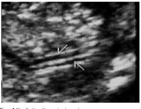 Figure 3 From Fetal Renal Duplicated Collecting System At 14 16 Weeks