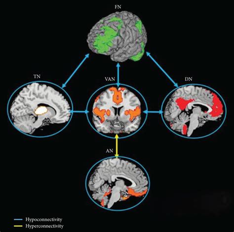 The Salience Network Reduced Connectivity Within The Salience Download Scientific Diagram