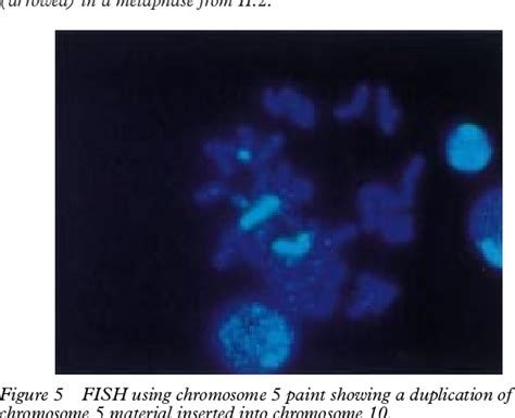 Figure 5 From The Cag Repeat Within The Androgen Receptor Gene In Male Figure 5 From The Cag Repeat Within The Androgen Receptor Gene In Male