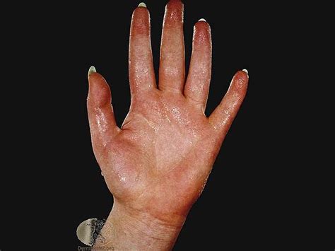 Hyperhidrosis Five Things To Know