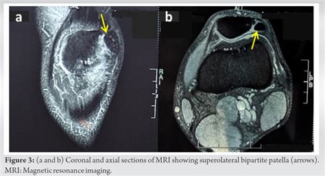 Bipartite Patella In An Elite Football Player A Rare Cause Of