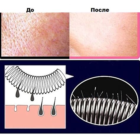 Mechanical epilator for the face: device and application, which is ...