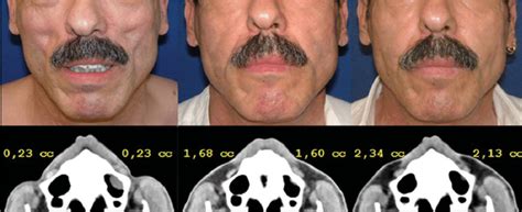 This 52 Year Old Man Demonstrates Grade 3 Facial Lipoatrophy In Each