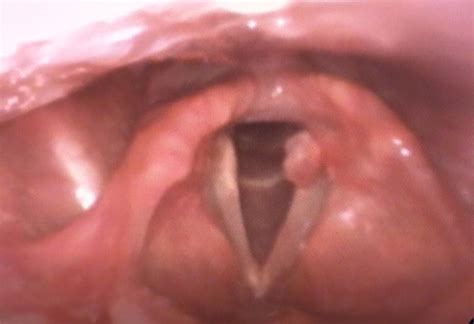 Characteristic Presentation Of Vocal Process Granuloma Note