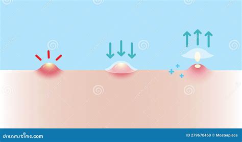 Acne Pimple Patch For Pustule Vector Illustration On Blue Sky Background