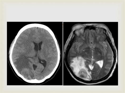 Neuro Radiology Neuroimaging Pptx