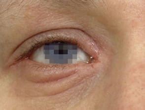Imágenes De Dermatitis Atópica El Sitio De Tu Piel