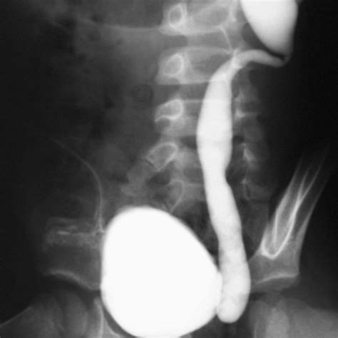 Follow Up Voiding Cystourethrogram Normal Appearance Of The Urethra