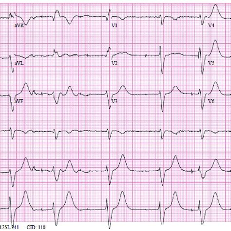 Electrocardiogram After Pacemaker Adjustments Download Scientific Diagram