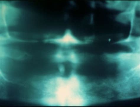 Cdrp Lecture 5 Classification Of Complete Edentulism Flashcards Quizlet