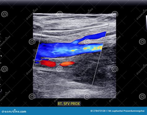 Ultrasound Diagnosis Of Lower Extremity Venous Thrombosis