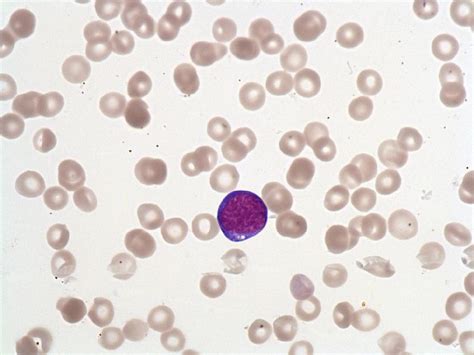 L3 Lymphoblast Burkitt Type HORIBA