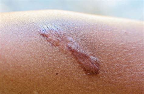 Journal Of Aesthetic Nursing Hypertrophic Scar Management