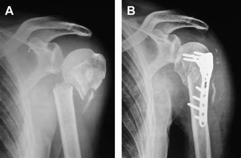 Labeled Humerus Xray At Debra Millender Blog