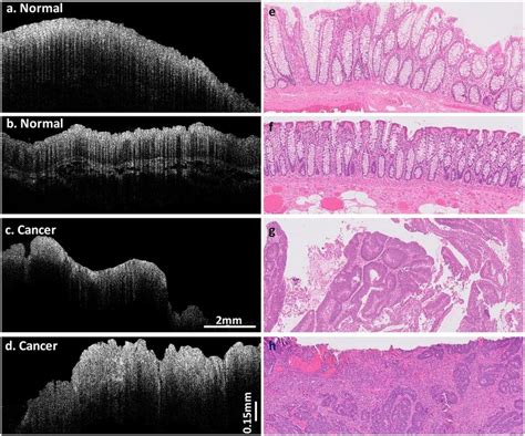 OCT Images Of Normal And Cancer Colon Specimens A B Are Typical Download Scientific Diagram